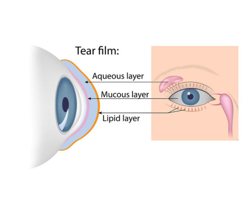 Dry Eye, Littleton, CO | Eyecare Center of Ken Caryl